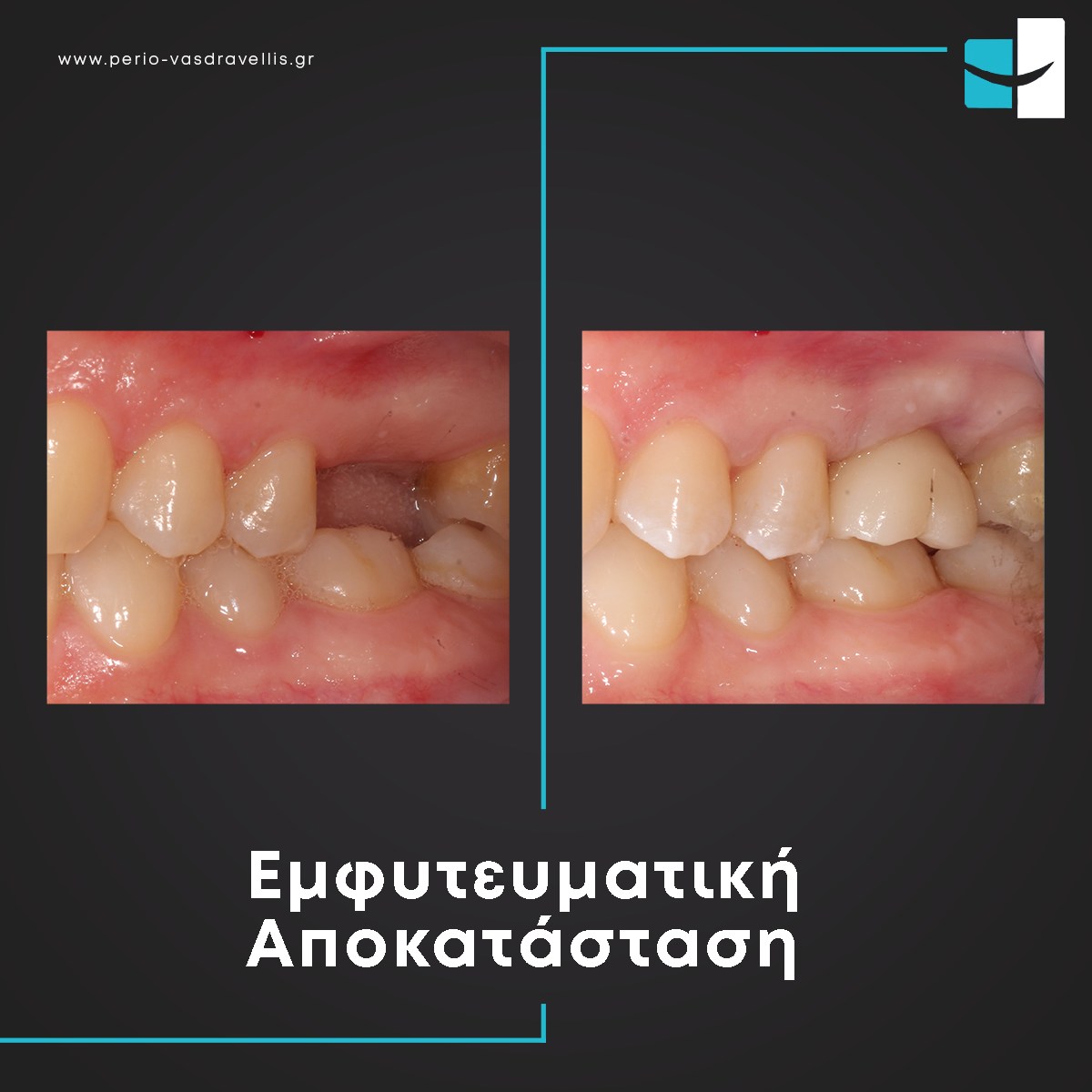 Our cases: Εμφυτευματική θεραπεία - Δημήτριος Βασδραβέλλης Οδοντίατρος ...